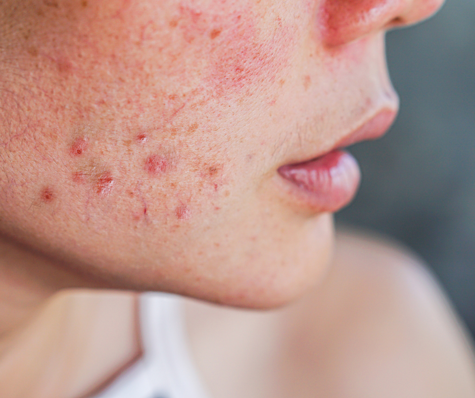 The Effectiveness of Antimicrobial Face Spray in Tackling Persistent ...